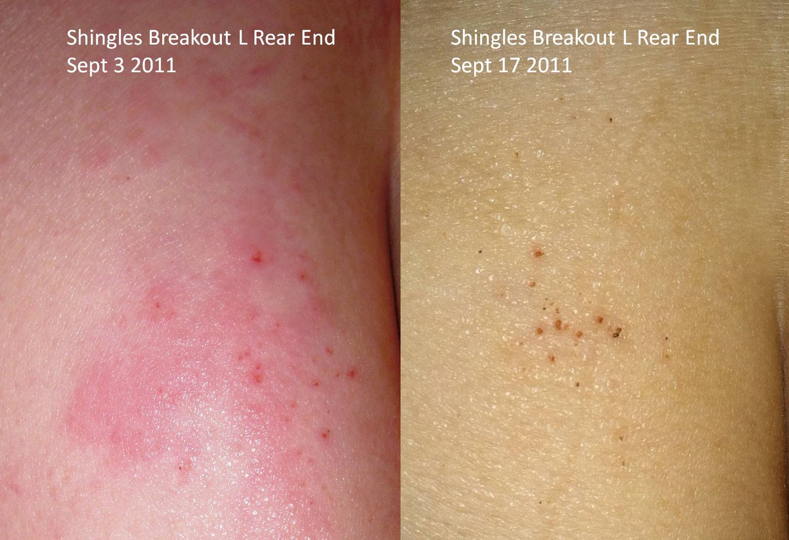 jm's Adventure with Multiple Myeloma: Day 4 Afternoon Update September ...