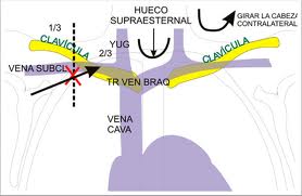 El Blog de Alfredo Garcia: ACCESOS VENOSOS CENTRALES. YUGULAR INTERNA ...