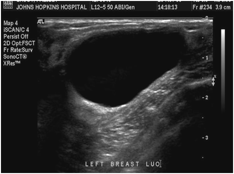 Breast Health is Your Health: Types of Breast Masses (Benign and Malignant)