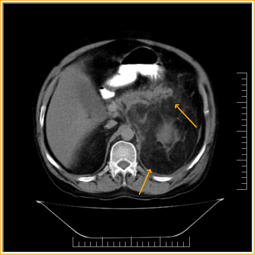 Perirenal Liposarcoma-CT - Sumer's Radiology Blog