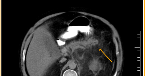 Perirenal Liposarcoma-CT - Sumer's Radiology Blog