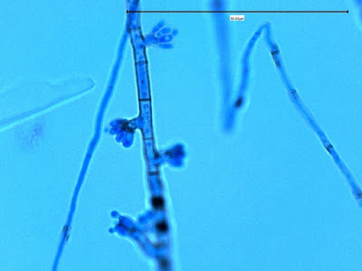 Fun With Microbiology (What's Buggin' You?): Fonsecaea pedrosoi/monophora