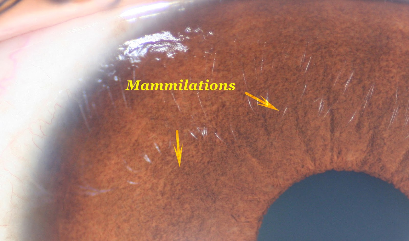 Modern & Multidimensional Iridology: Mammilations, Radial Furrows & The ...