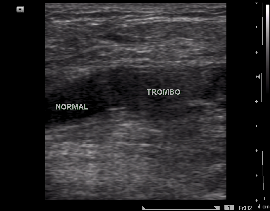 KLINIK PRATAMA MAKMUR JAYA: USG Vaskuler Penyumbatan Darah Balik (Vena ...