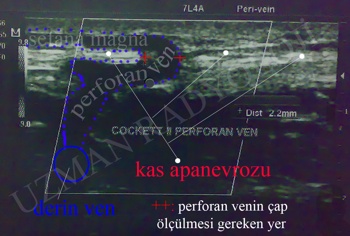 Ekstremite venöz anotomi, Kronik venöz yetmezlik