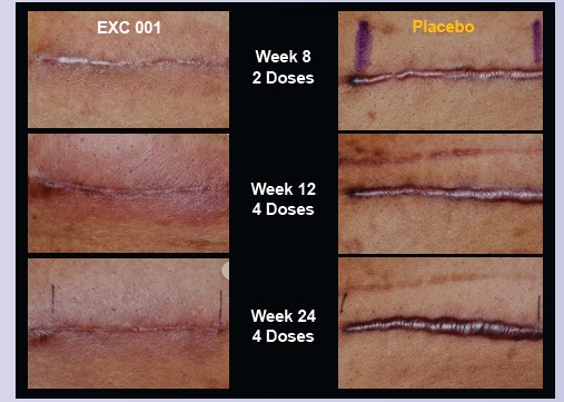 RNAi Therapeutics: Antisense Comparison Provides Hope for RXi’s Dermal ...