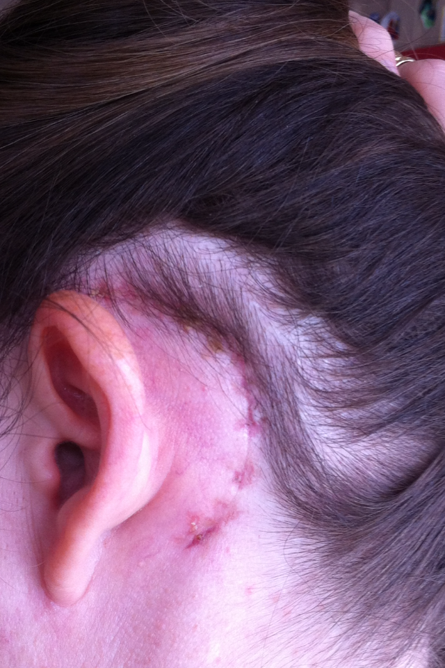 Colored With Memories: Acoustic Neuroma - 9 Weeks Post Op (including ...