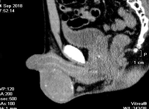 VIETNAMESE MEDIC ULTRASOUND: CASE 512: TESTICULAR TUMOR, Dr PHAN THANH ...