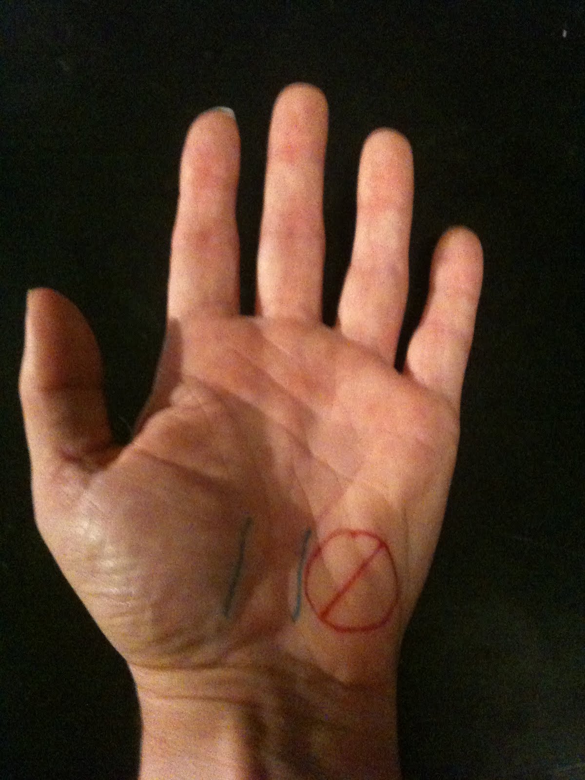 Ulnar Neuropathy - Trimazing