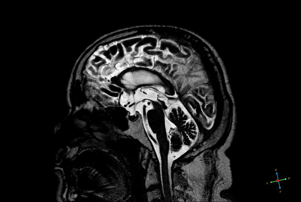 NPH and CSF flow studies - Radiology Imaging