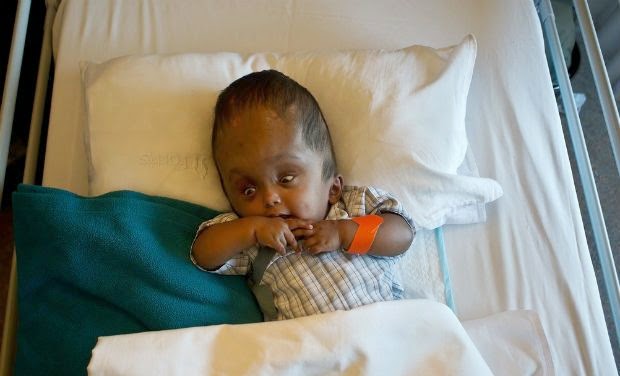 Toddler with Hydrocephalus smiles for the first time ~ PublicWellness Group