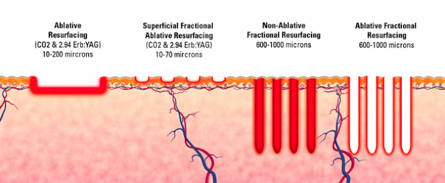 Aesthetics 101 (Part 4): Introduction to LASER, Laser Types and Indications