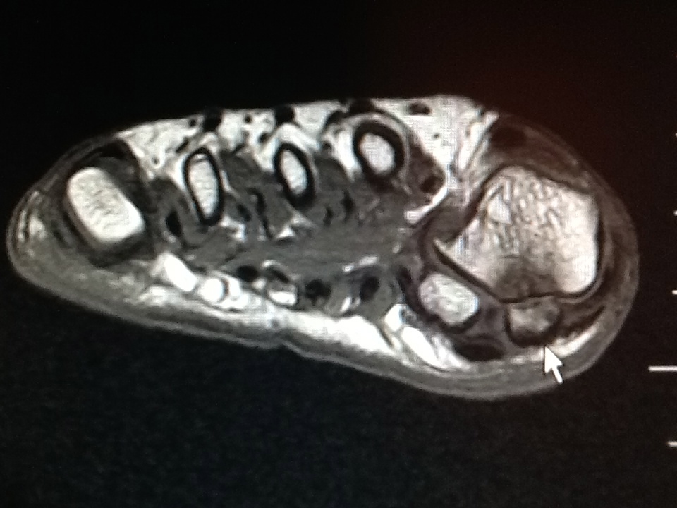 Foot and Ankle Problems By Dr. Richard Blake: Sesamoid Injury: MRI ...