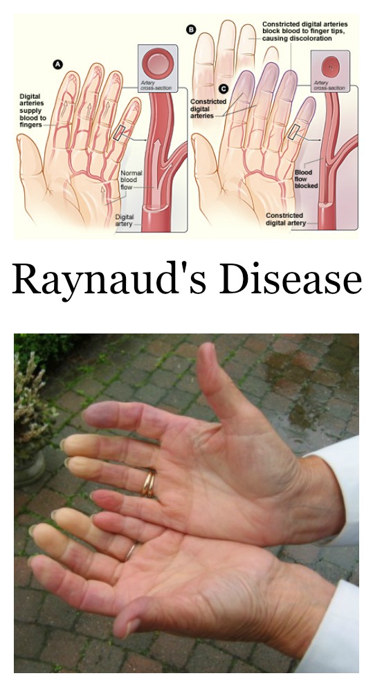 Raynaud's Disease Syndrome?