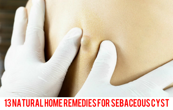 13 Natural Home Remedies For Sebaceous Cyst 3inaa