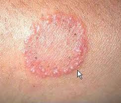 Noer Prasetya: TINEA CORPORIS