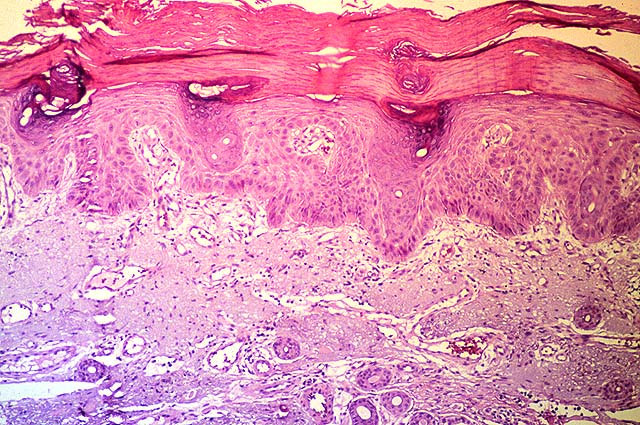 Neoplasias Dermicas: Queratosis Actínica