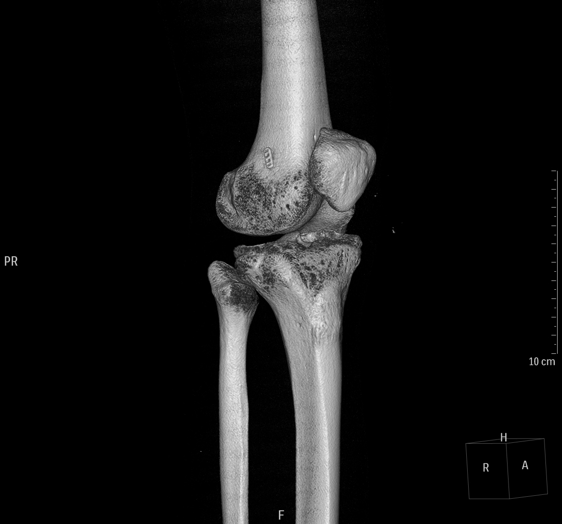 CT Knee - Radiology Imaging