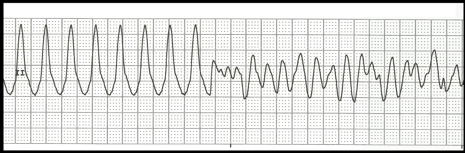 Basic EKG Rhythm Test 04