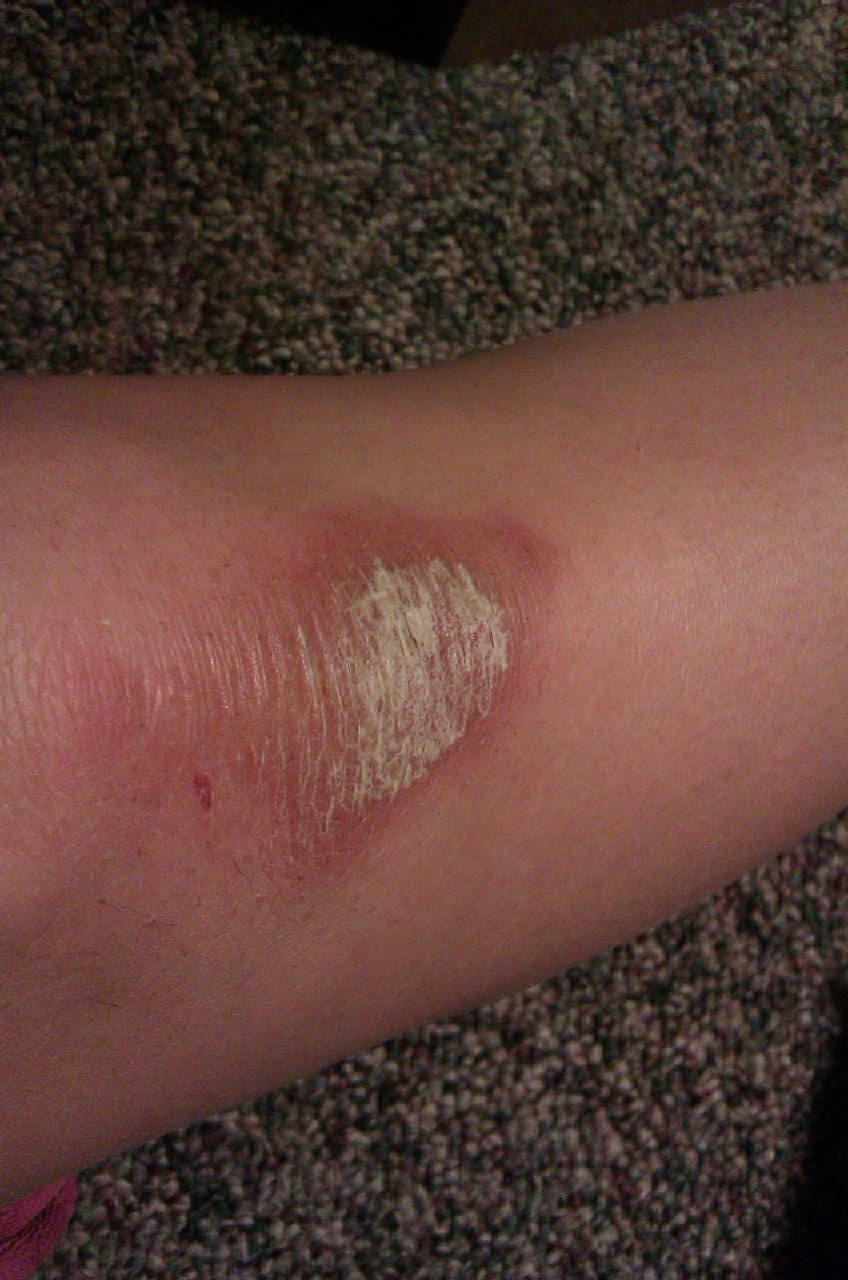 GAPS for Psoriasis: Psoriasis