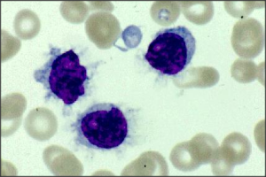 FICHERO DE HEMATOLOGIA: LLC- LEUCEMIA DE CÉLULAS PILOSAS (Tricoleucemia)