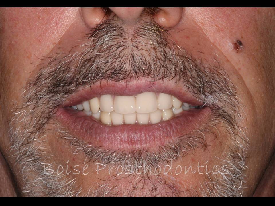 Boise Idaho Prosthodontics: Picture Sequence of Maxillary Complete ...