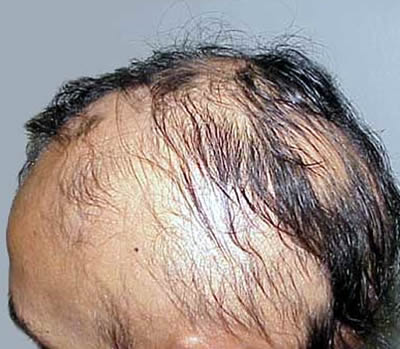 Free For Health: Alopecia - Definition, Causes, Symptoms and Treatment