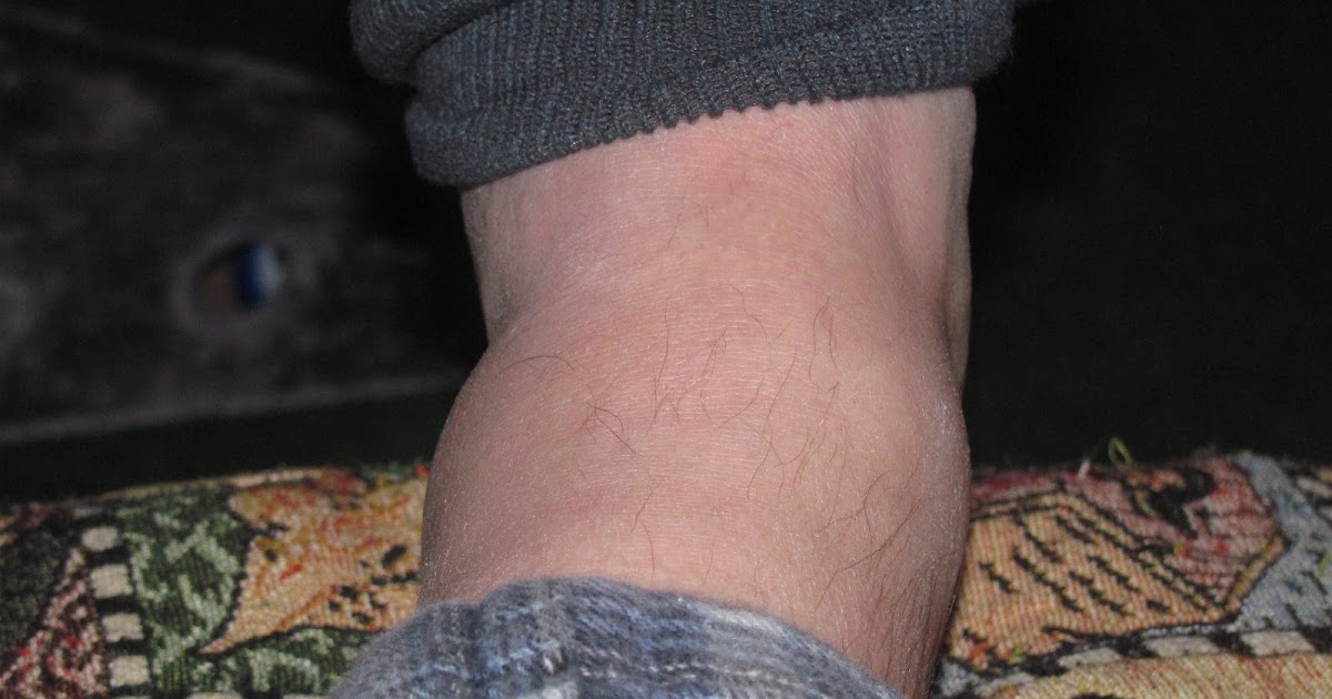 The World of Gord: Caring for a Sprained Ankle