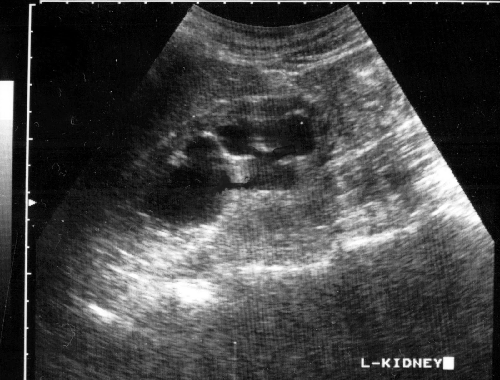 ecografie imagini medicina renal Renal nativ Hidronefroza | Terapii ...