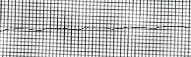 Interpretacion EKG: 2015