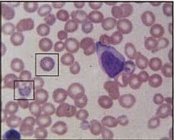 Células importantes en hematología: PUNTEADO BASOFILO