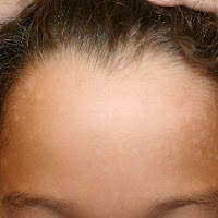 Panu, Penyebab, Gejala dan Cara Mengobati - Penyakit