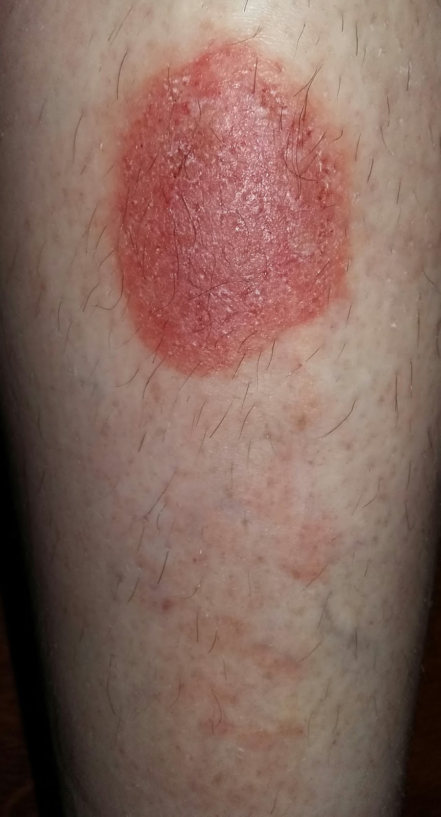 Testuje, opiniuje produkty warte uwagi: Pałeczka ropy błękitnej rana