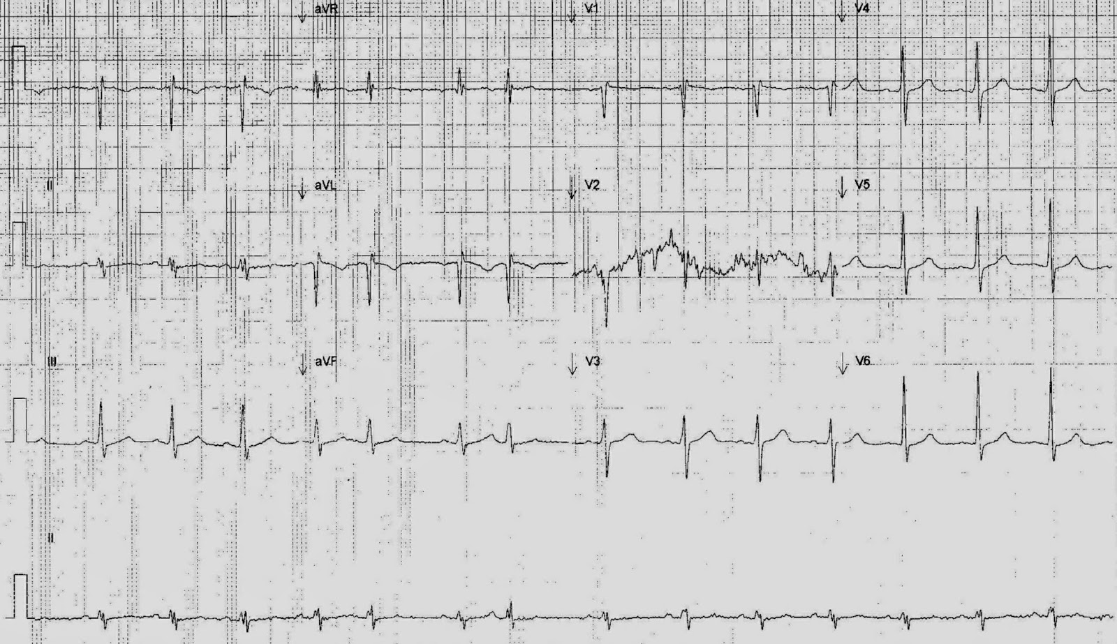ECG of the Week: ECG of the Week - 27th October 2014