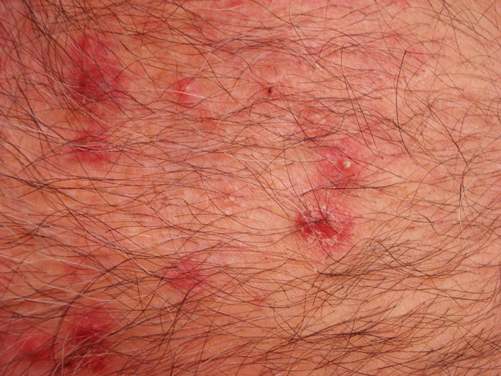 VIRTUAL GRAND ROUNDS IN DERMATOLOGY 2.0: Pustular Folliculitis