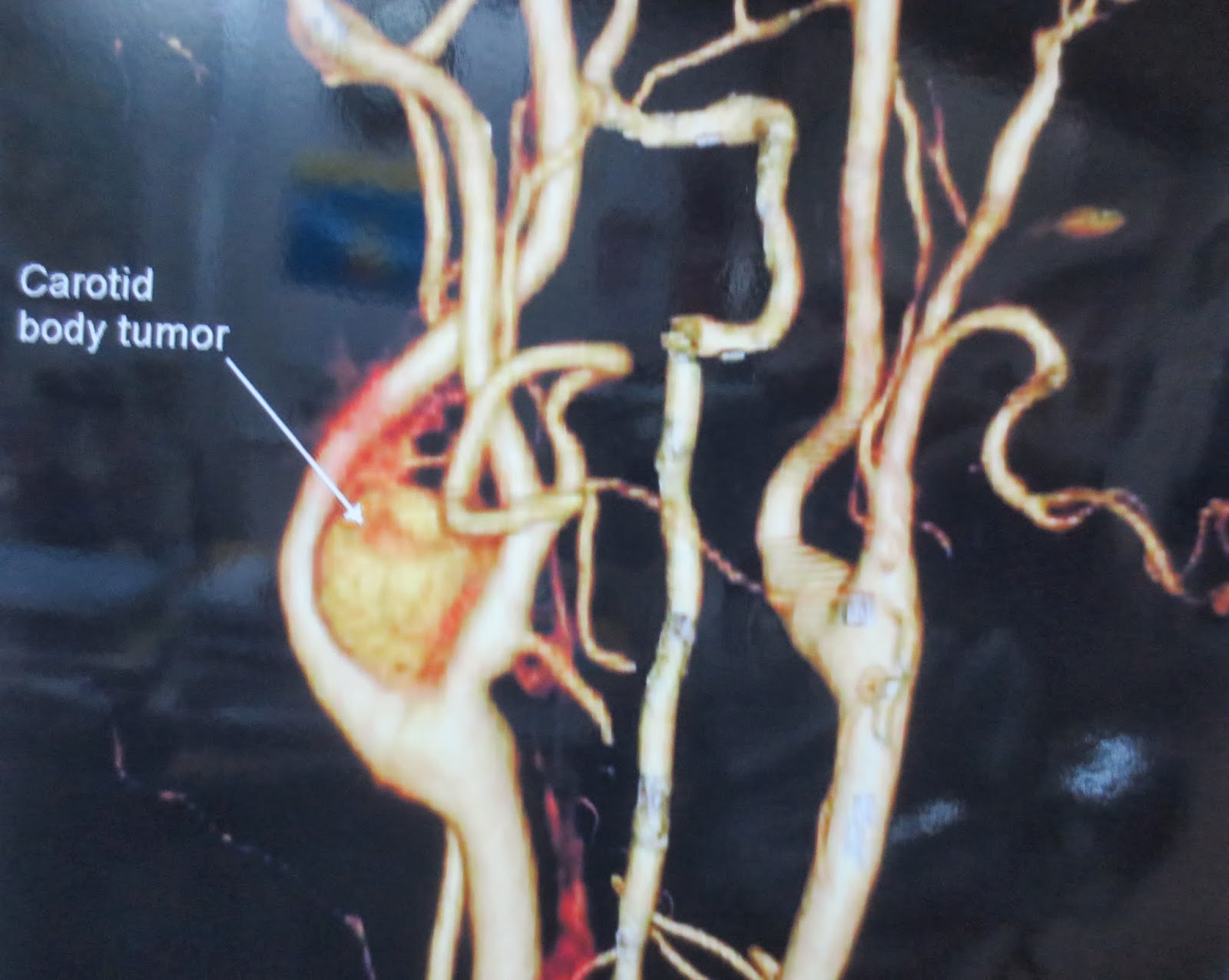 VIETNAMESE MEDIC ULTRASOUND: CASE 234: CAROTID BODY TUMOR, A LATERAL ...
