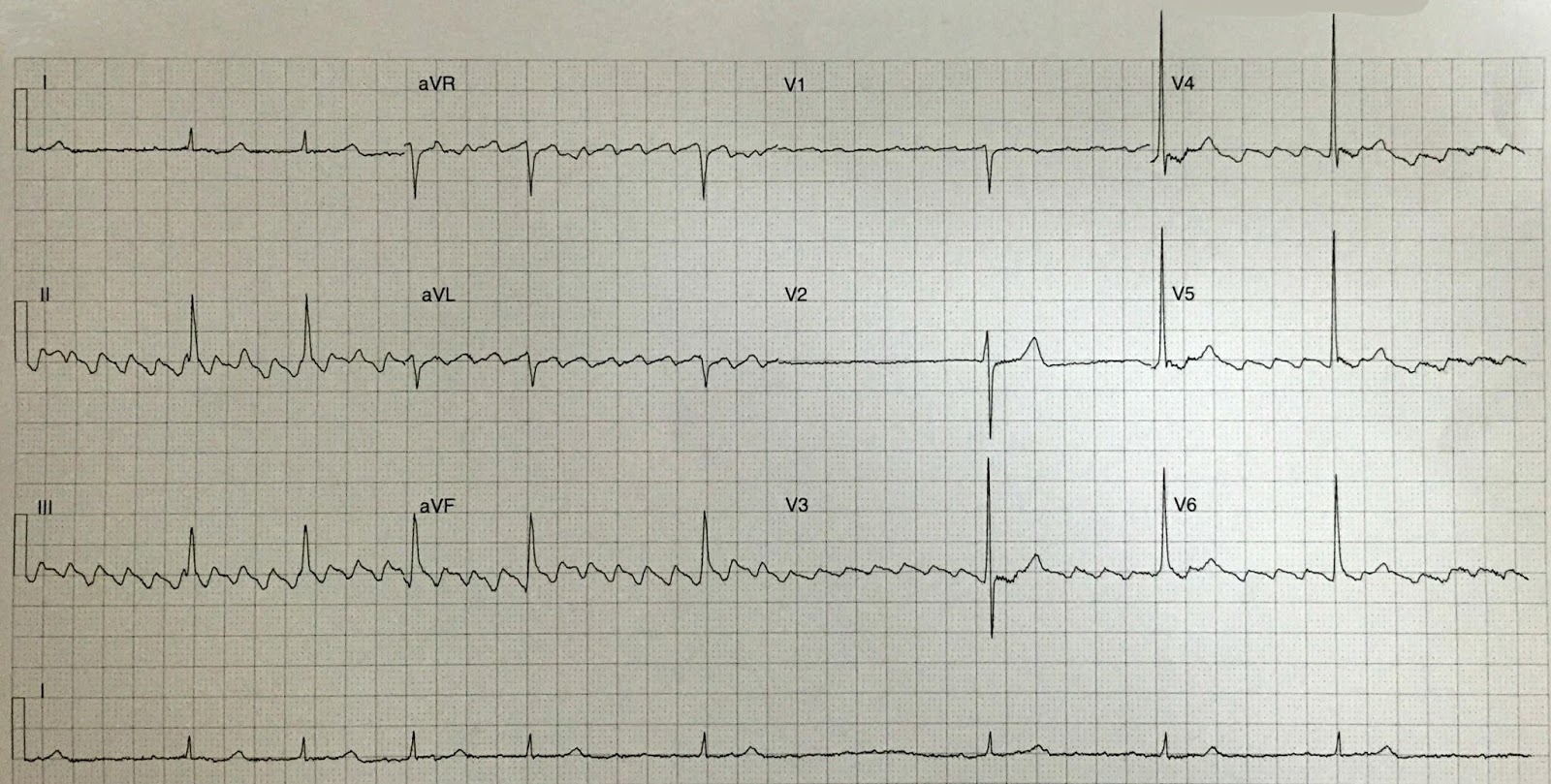 ECG of the Week: ECG of the Week - 21st September 2015 - Interpretation
