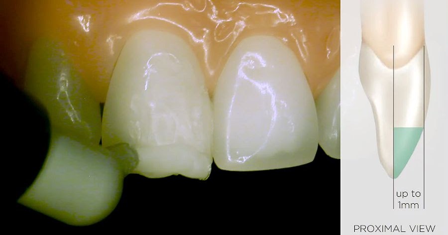 DENTAL MATERIALS: TPH Spectra ST® Effects Composite Helps Simplify ...