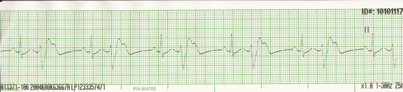 EKG Rhythm Strips: Bigeminy, Trigeminy, Quadrageminy