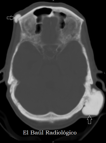 El Baúl Radiológico: OSTEOMAS CRANEALES. (Cranial Osteomas. CT Findings ...