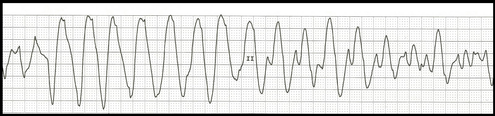 ECG Rhythm Strip Quiz 93