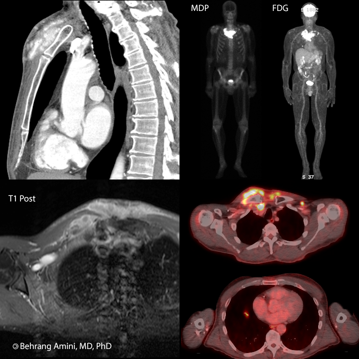 Roentgen Ray Reader: Radiation-Associated Sarcomas