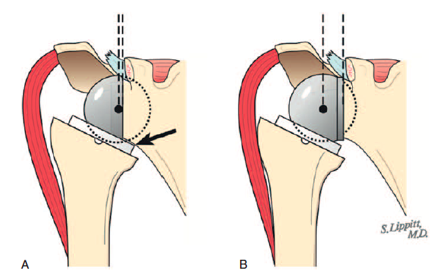 UW Shoulder and Elbow Academy: Scapular notching, it's not about the ...