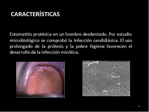 PROSTODONCIA TOTAL: Estomatitis protesica