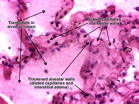 موقع الدكتور أحمد كلحى: صور باثولوجى - Pathology Slides : Pulmonary ...