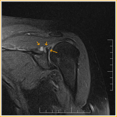 Paralabral Cyst: MRI - Sumer's Radiology Blog