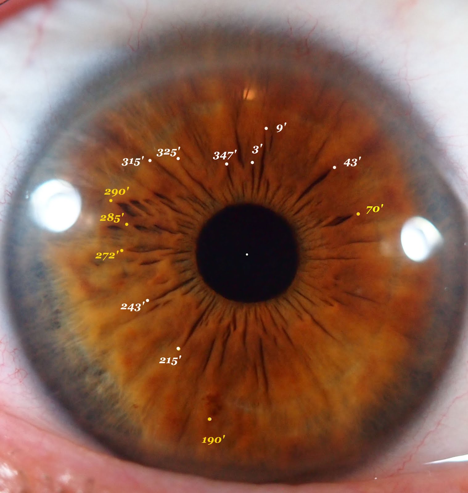 Modern & Multidimensional Iridology: Mixed Biliary Constitution in ...