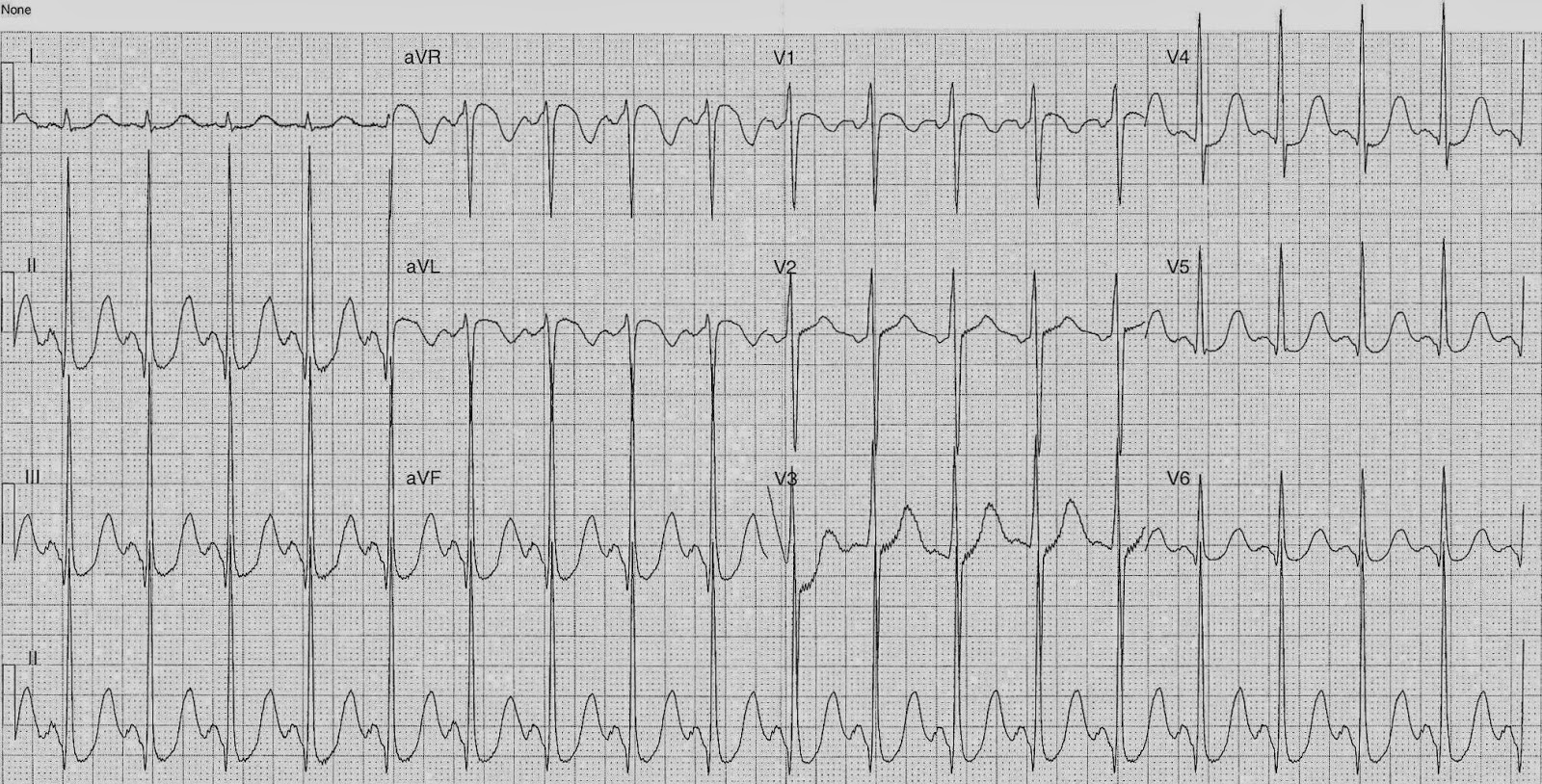 ECG of the Week: ECG of the Week - 28th July 2014 - Interpretation