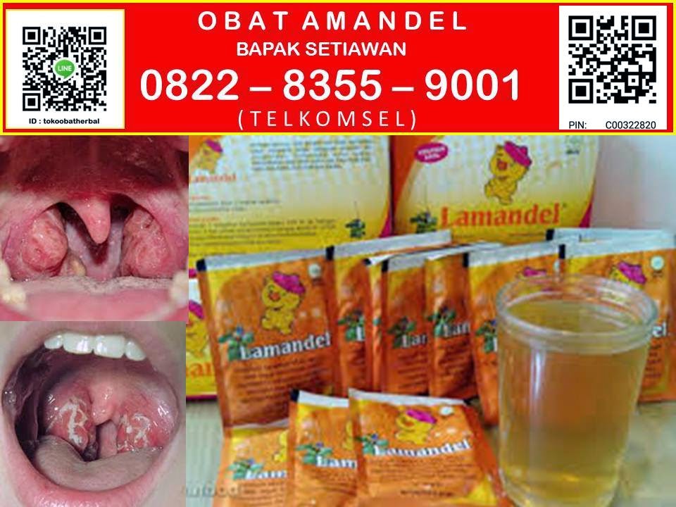 Sakit Amandel Pada Orang Dewasa - Info Kesehatan