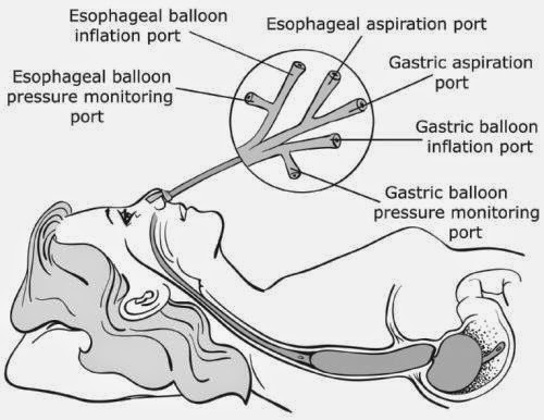 Procedures Club: The Blakemore Tube